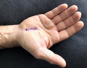 Endoscopic carpal tunnel release surgery - Perth Orthopaedic Specialist ...