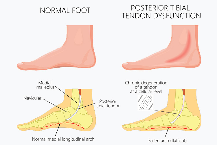 Adult Flat Foot Posterior Tibial Tendon Dysfunction Perth Orthopaedic