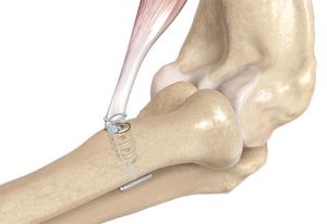 Distal Biceps Rupture and Tendon Reconstruction - Perth Orthopaedic Specialist Centre