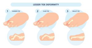 Lesser Toe Deformities - Perth Orthopaedic Specialist Centre
