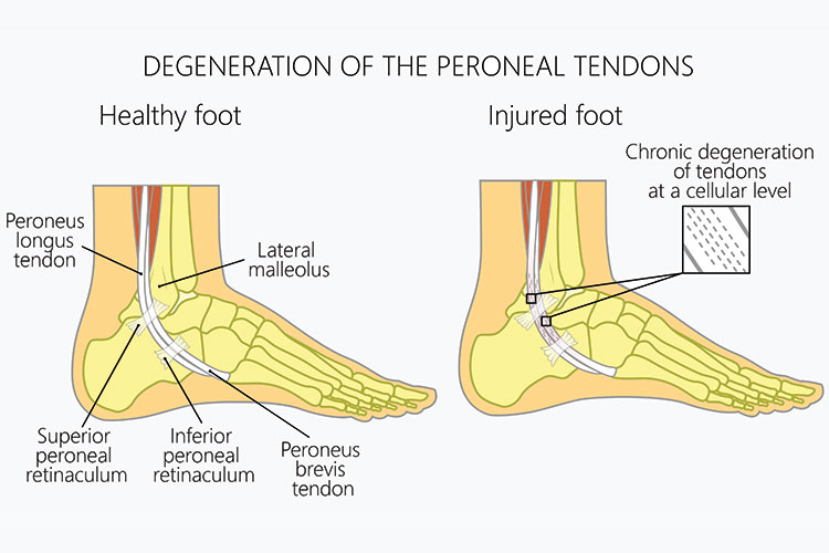 Transfer Foot Online