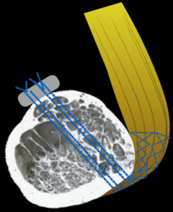 Distal Biceps Rupture and Tendon Reconstruction - Perth Orthopaedic ...